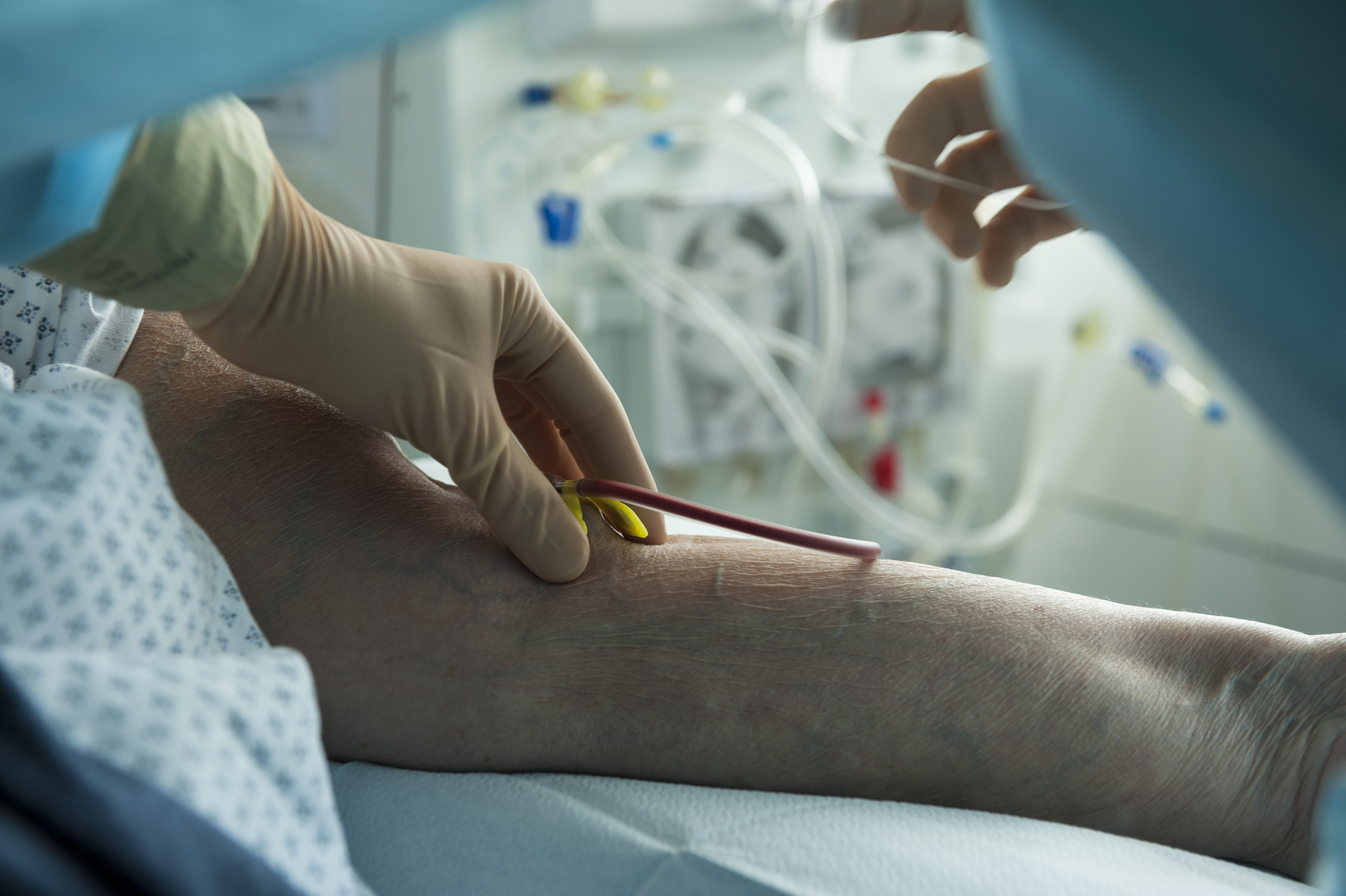 Hémodialyse : la douleur lors des ponctions de la fistule – NEPHROHUG