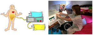 Les deux méthodes de dialyse péritonéale – NEPHROHUG