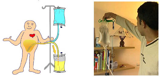 Les deux méthodes de dialyse péritonéale – NEPHROHUG